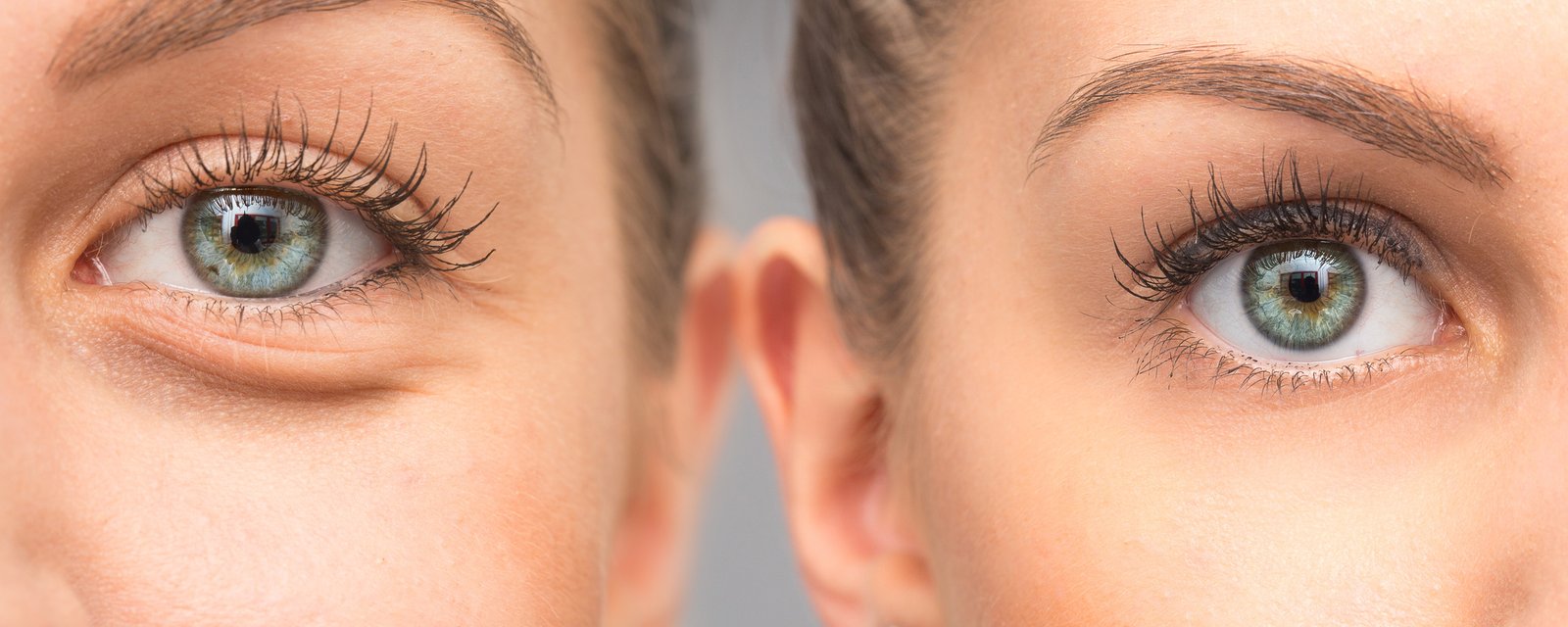 8 façons naturelles d'éliminer les cernes sous les yeux - Trucs et ...