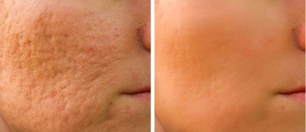 10 méthodes pour soigner et atténuer tous les types de cicatrices ...