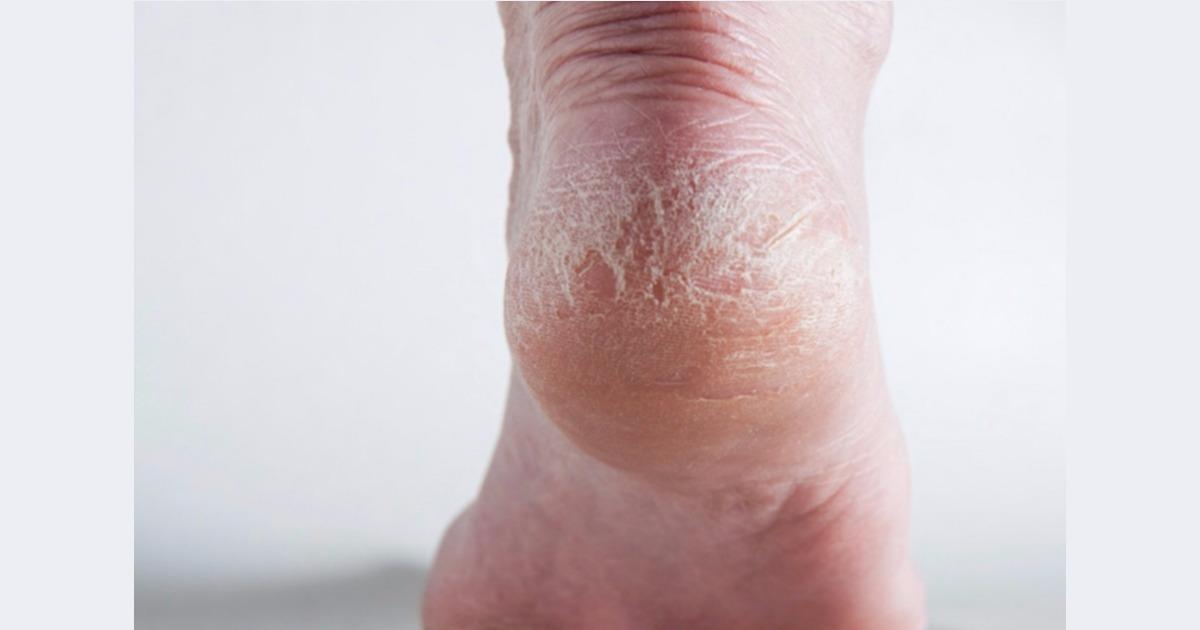 Retrouvez des talons tout doux en quelques jours grâce à cette petite ...